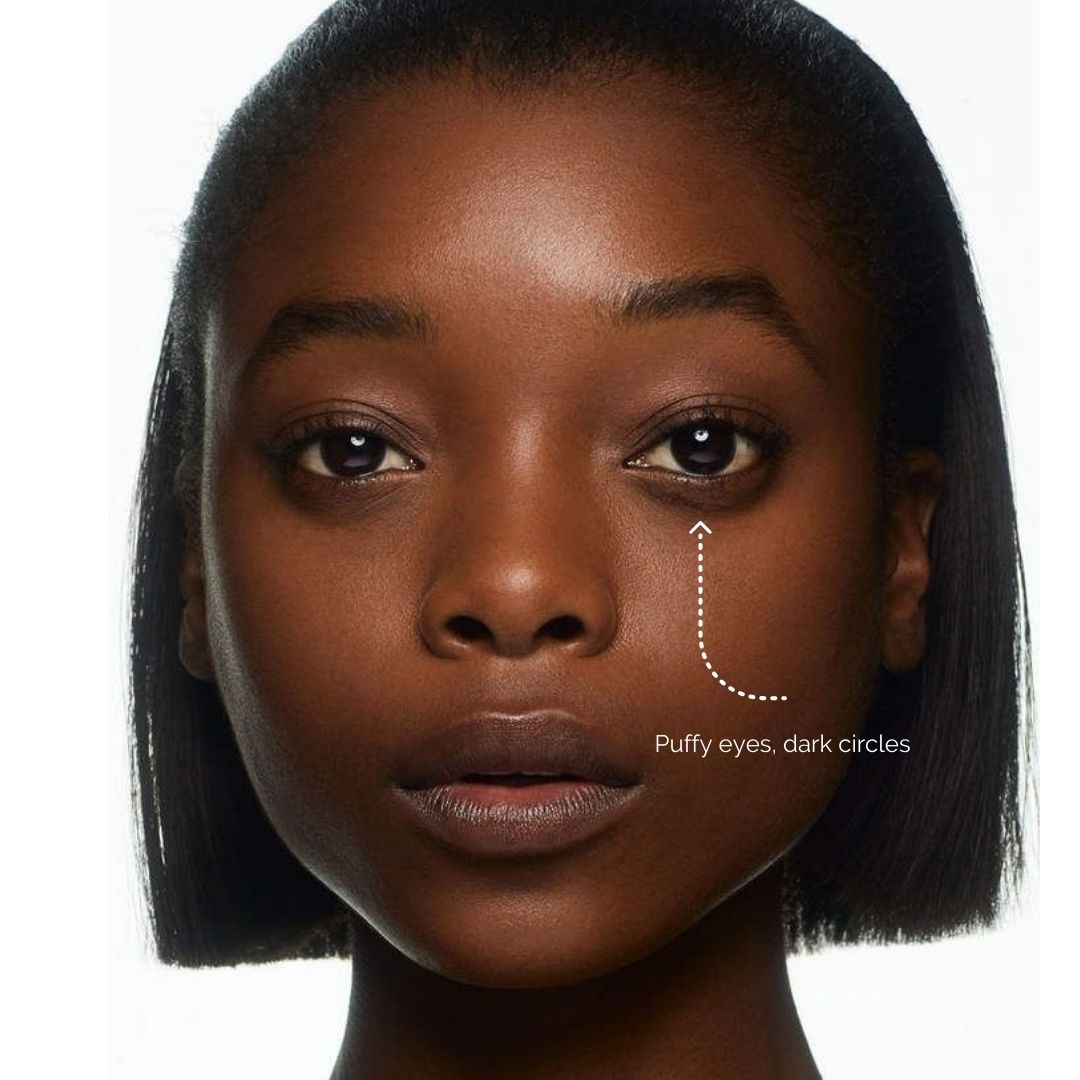 Struggling with Puffy Eyes? Evaluate and Try This to Help | YELLE-Skin ...